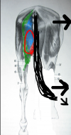 Groin Muscle Injuries – How, why, & the function test | Dr. Mel Newton